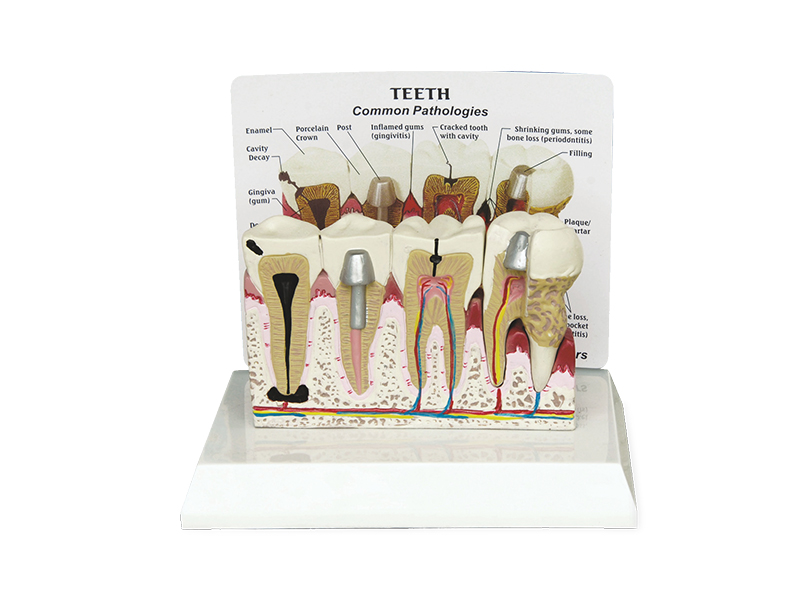 Dental pathology model :: PETONA.cz